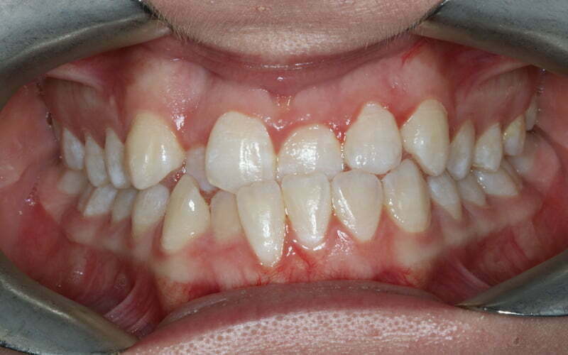 Cases Colchester Teeth Straightening Orthodontist Ipswich