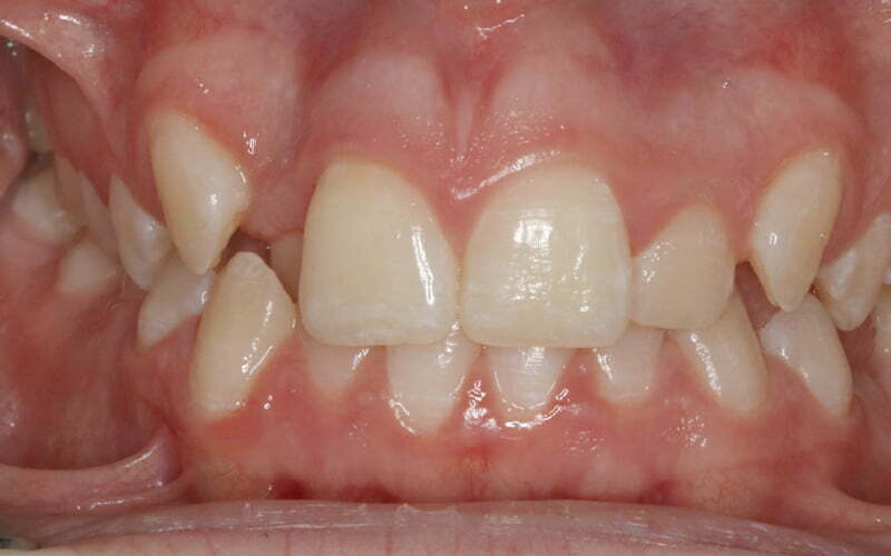 Cases Colchester Teeth Straightening Orthodontist Ipswich