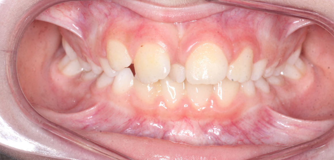 Smile Gallery Colchester Teeth Straightening Orthodontist Ipswich
